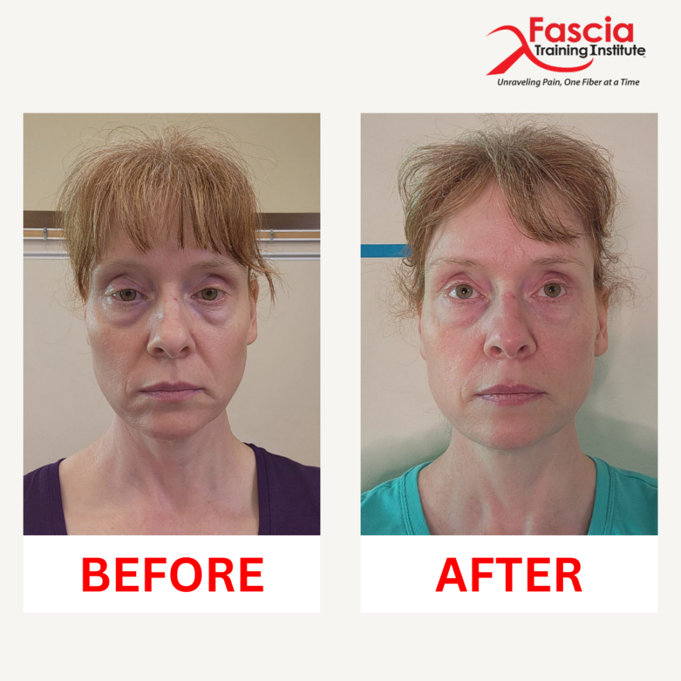 Fascia Training Institute | Concussion Recovery, Brain Healing and ...